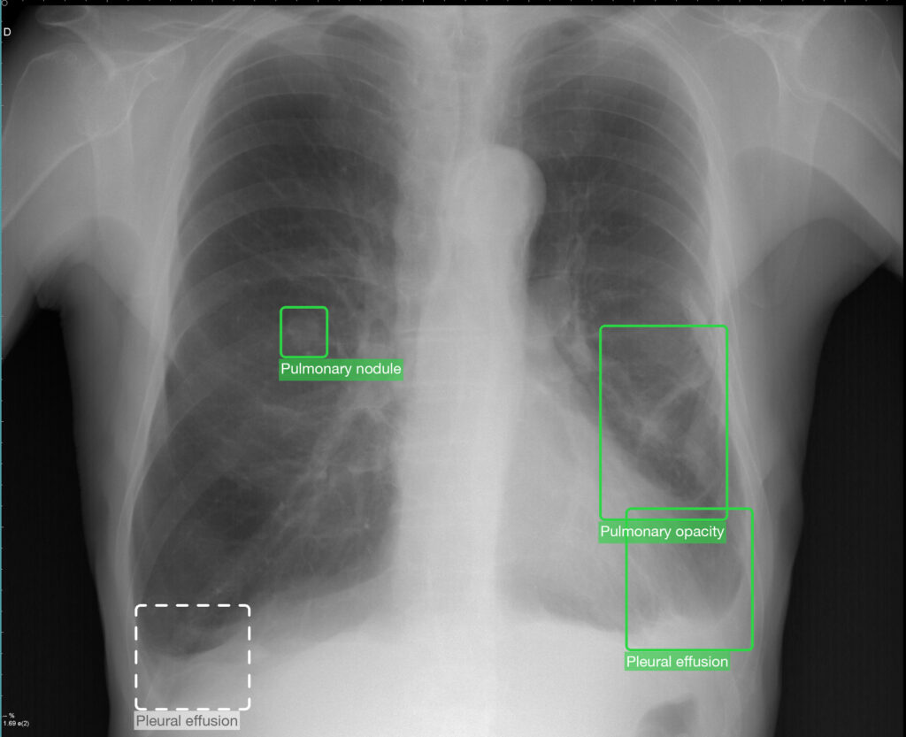 TechCare Chest - Milvue
